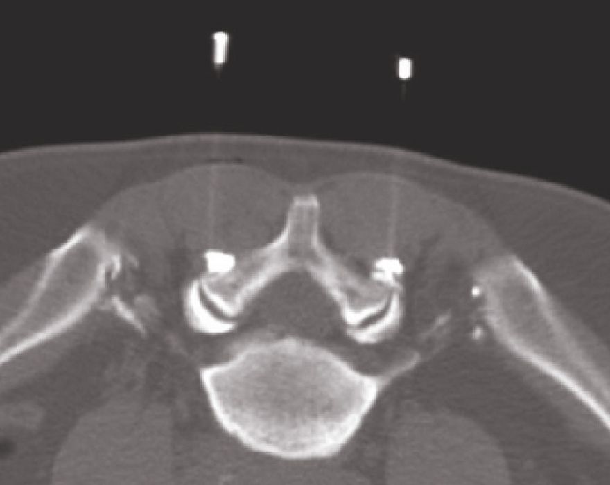 CT gesteuerte Schmerztherapie