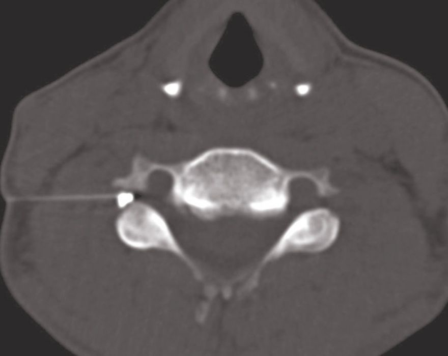 CT gesteuerte Schmerztherapie